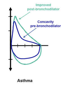 Understanding your spirometry test results